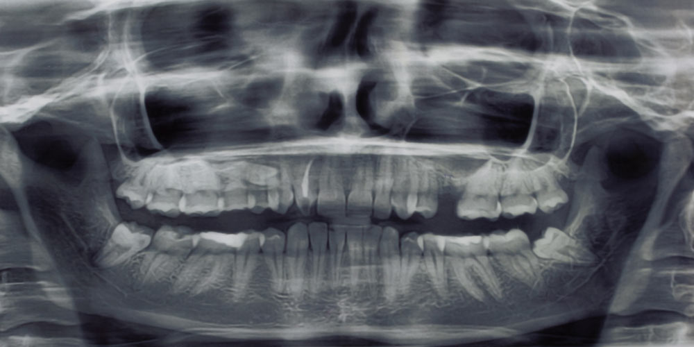 Extraction des Dents de Sagesse, Tout ce qu'il faut Savoir