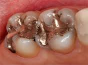 Les différences : Plombage gris, plombage blanc et restauration en ...