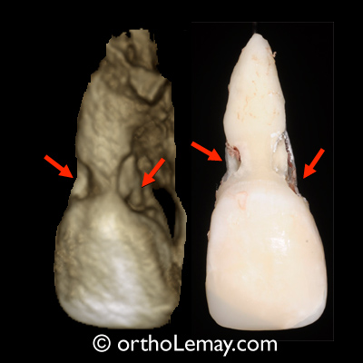 Résorption radiculaire et imagerie | Bücco